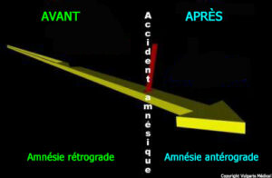 Amnésie rétrograde et amnésie antérograde - Anatomie, photo et illustration
