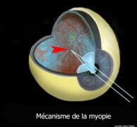 Myopie - mécanisme (schéma) - Anatomie, photo et illustration