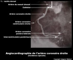 Angiocardiographie de l'artère coronaire droite - Anatomie, photo et ...