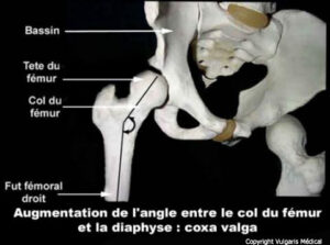 Coxa valga - Anatomie, photo et illustration