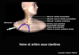 Veine et artère sous-clavière (localisation) - Anatomie, photo et ...