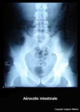 Aérocolie intestinale – Vulgaris-medical
