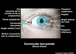 Caroncule lacrymale – Vulgaris-medical