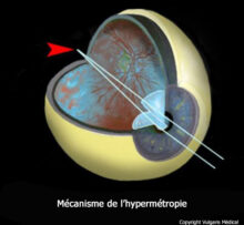 Hypermetropie (dessin explicatif) - Anatomie, photo et illustration