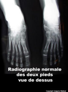 Pieds (radiographie normale vue de dessus) - Anatomie, photo et ...