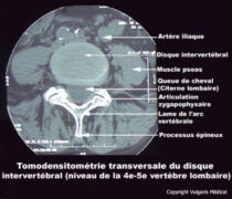 Tomodensitométrie du disque intervertébral passant par la 4e et 5e ...