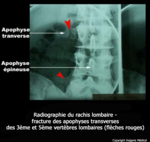 Fracture Vertèbre Lombaire L4: Fracture Vertebrale Lombaire Traitement ...
