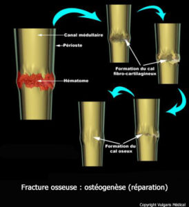 Fracture osseuse - Anatomie, photo et illustration