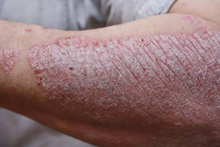 Comment soulager le psoriasis sur les parties sensibles du corps ...